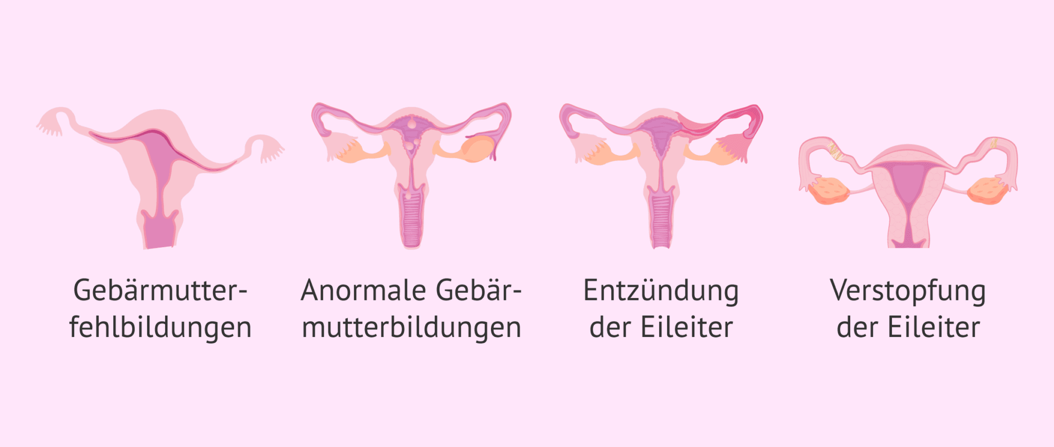 Informationen aus der Hysterosalpingographie