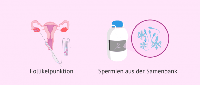 Die IVF mit Samenspende: Verlauf und Erfolgsquoten