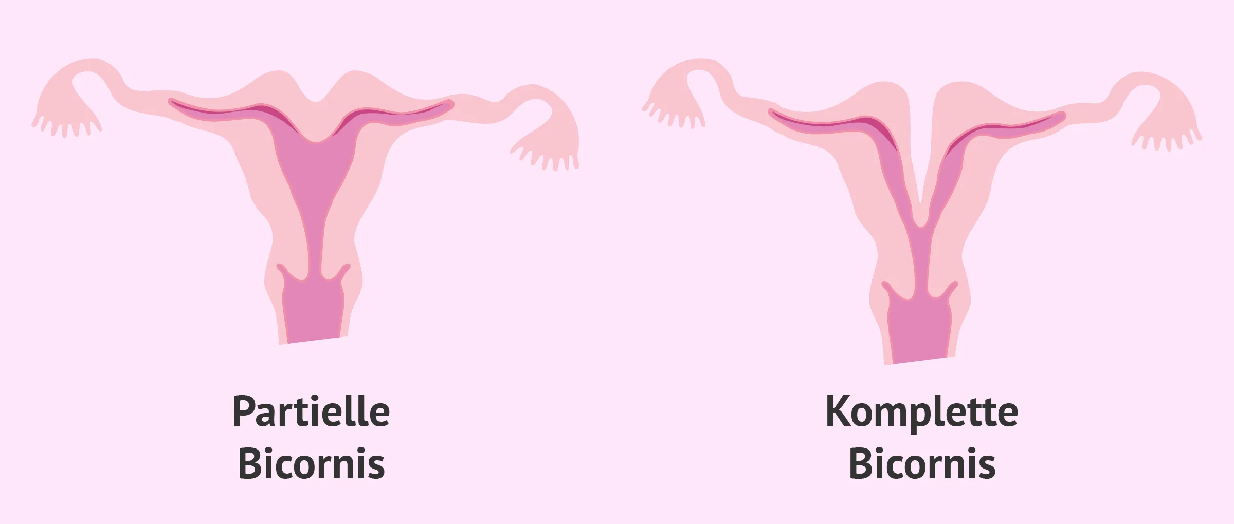 Uterus Bicornis En Tvdelad Livmoder Vad R Uterus